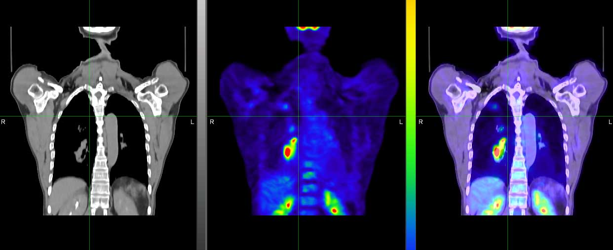 PET Scan Radiation Exposure To Family | Separating Fear from Facts ...